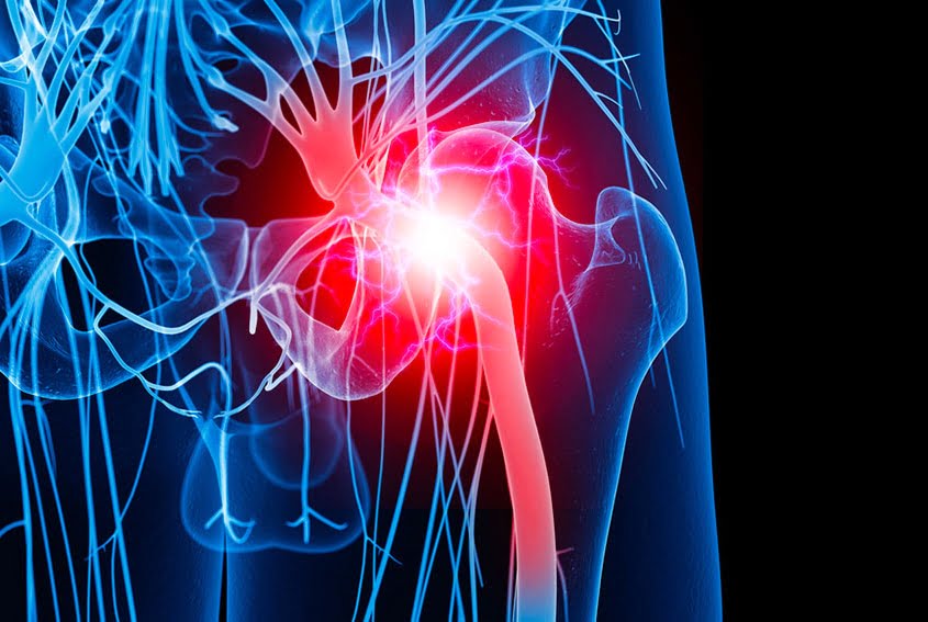 SCIATALGIE - Physio Élite