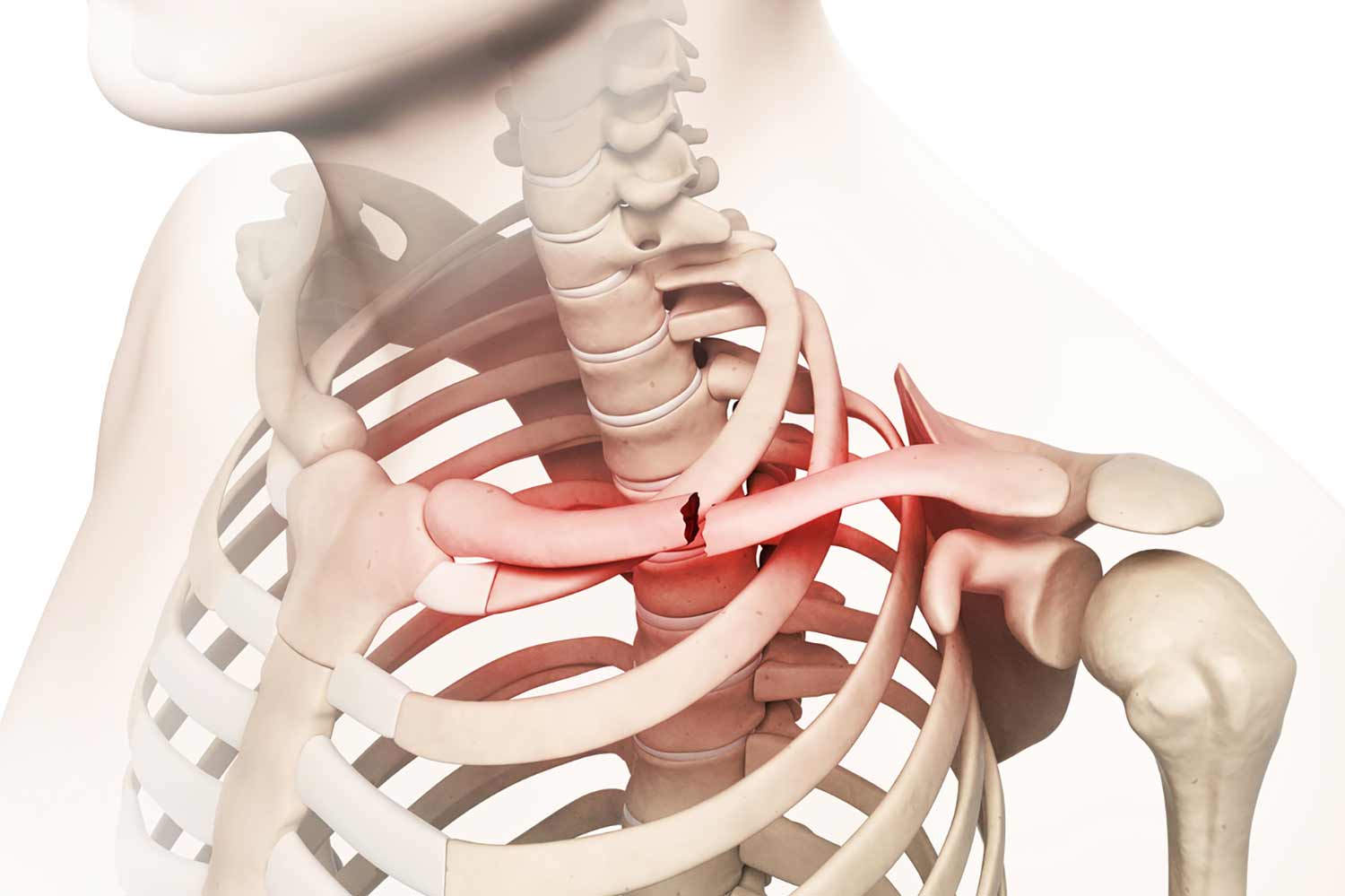 Clavicule Cassée: Symptômes et Traitement | Physio Élite